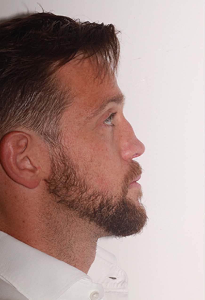 Results - Harley Street Nose Clinic